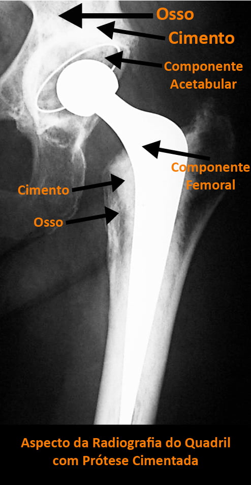 Próteses cimentadas | O quadril – especialista em cirurgia do quadril ...