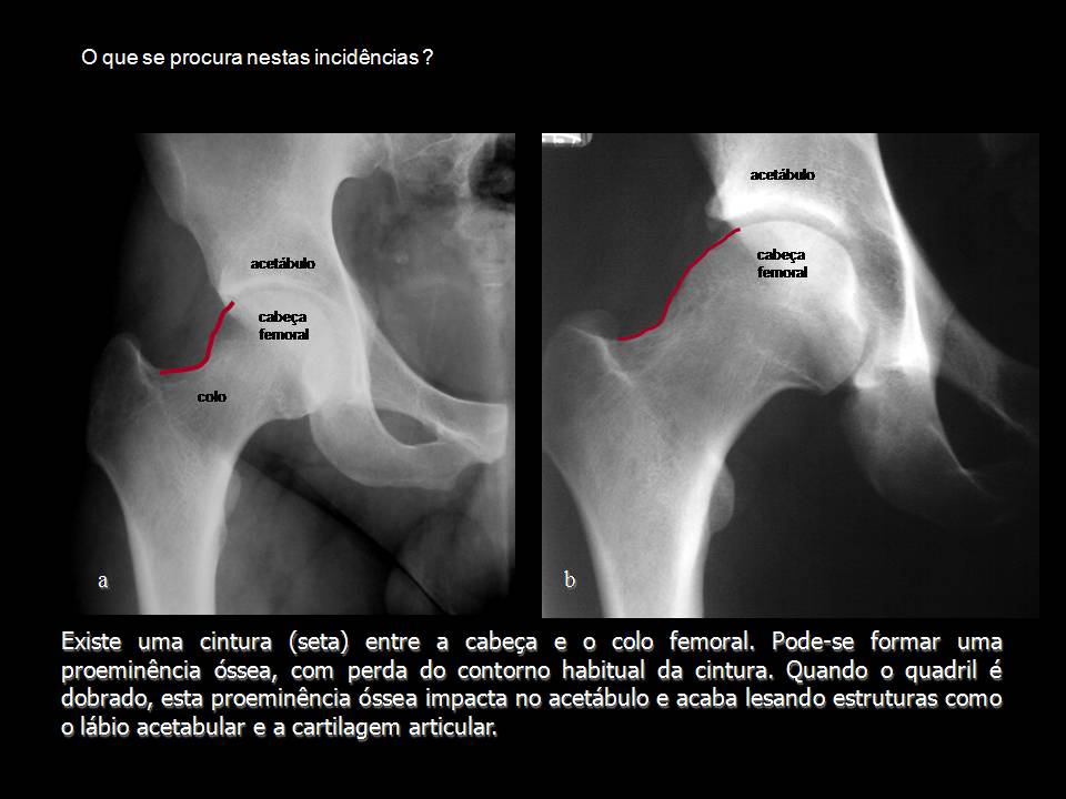A radiologia do quadril - Cirurgia, tratamento e reabilitação do quadril