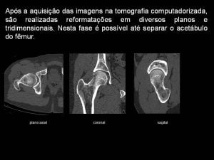 A radiologia do quadril - Cirurgia, tratamento e reabilitação do quadril